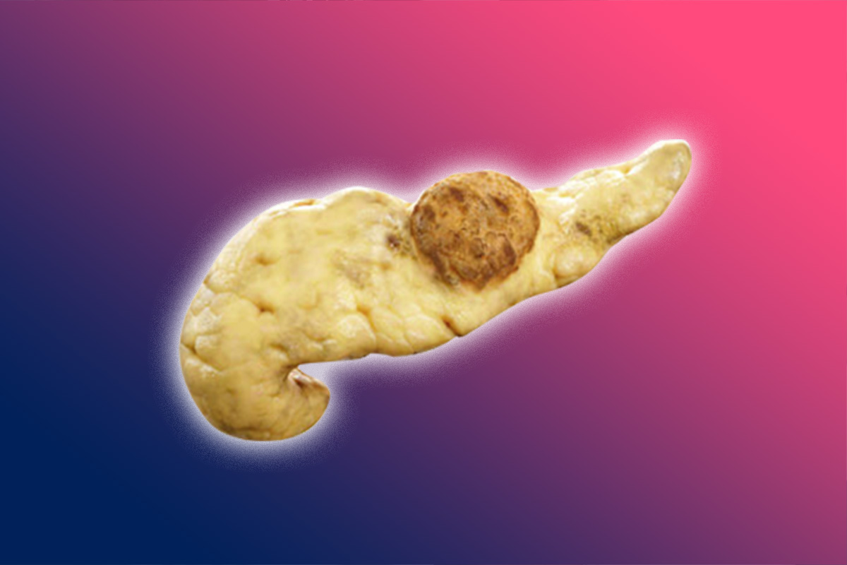 Why it matters - PANCAID